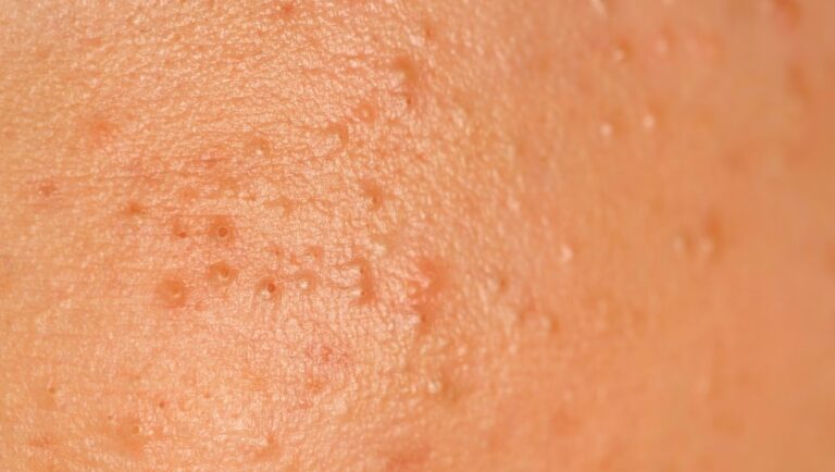 How To Get Rid Of Acne On The Stomach? Expert Tips for Smooth, Clear ...