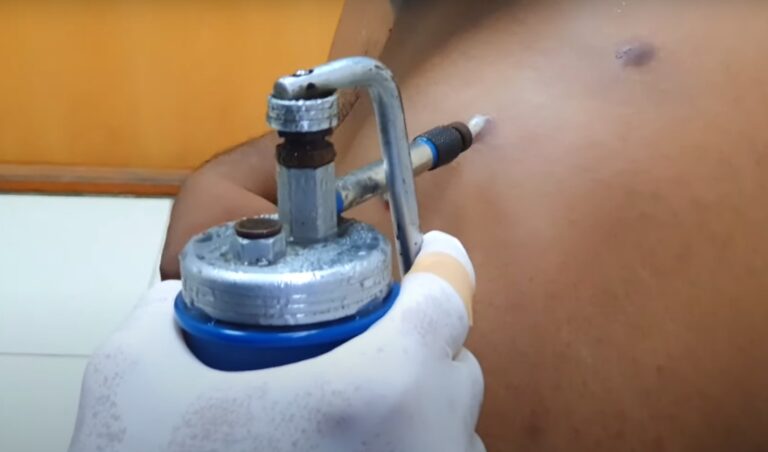 How To Get Rid Of A Frostbite Scar? Follow These Methods and Additional ...