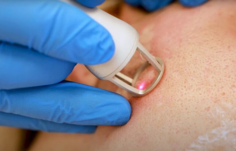 How To Get Rid Of A Frostbite Scar? Follow These Methods and Additional ...