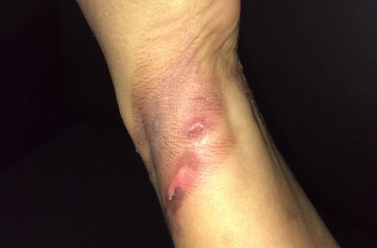 How To Get Rid Of A Frostbite Scar? Follow These Methods and Additional ...